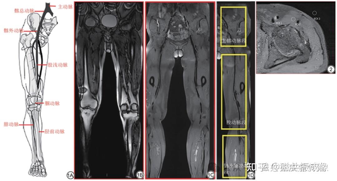 基于多序列磁共振血管壁成像的下肢动脉病变诊断研究 - 知乎