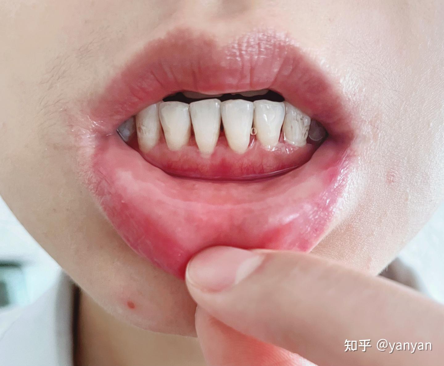 牙周膜龈手术+植骨（PAOO）记录 - 知乎