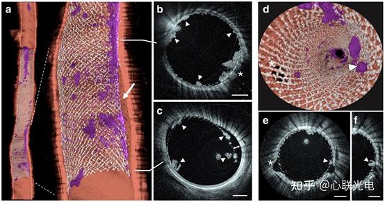 脑血管原位显微成像——一种可用于神经血管成像的HF-OCT系统 - 知乎
