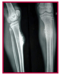 第四十八章 骨肿瘤病人的护理 - 知乎