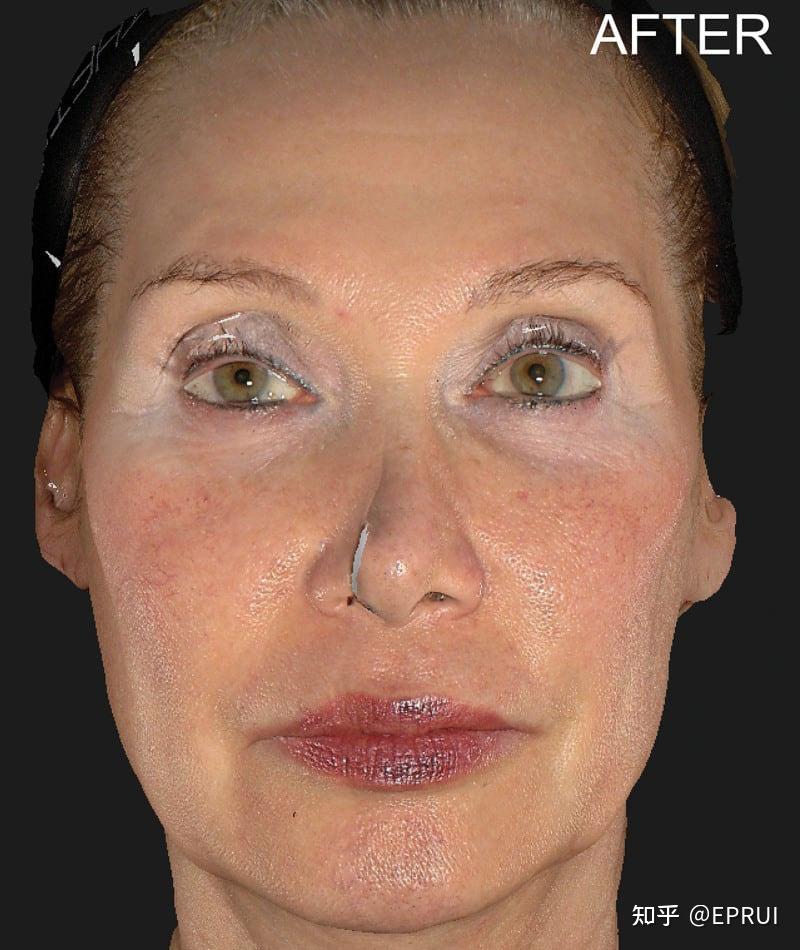 25-45um 医美用CaHA羟基磷灰石微球 - 知乎