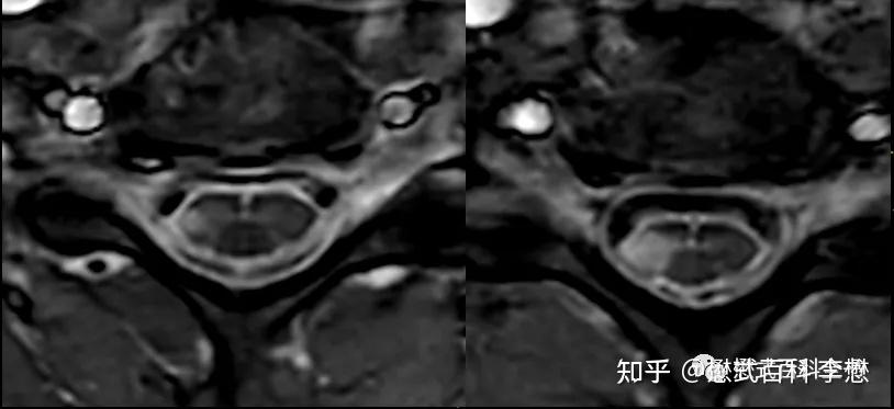 PSIR序列原理及临床应用 - 知乎
