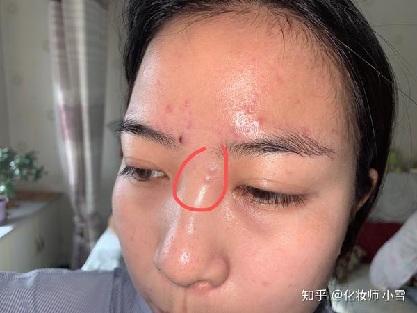期待痘痘好的每一天 知乎
