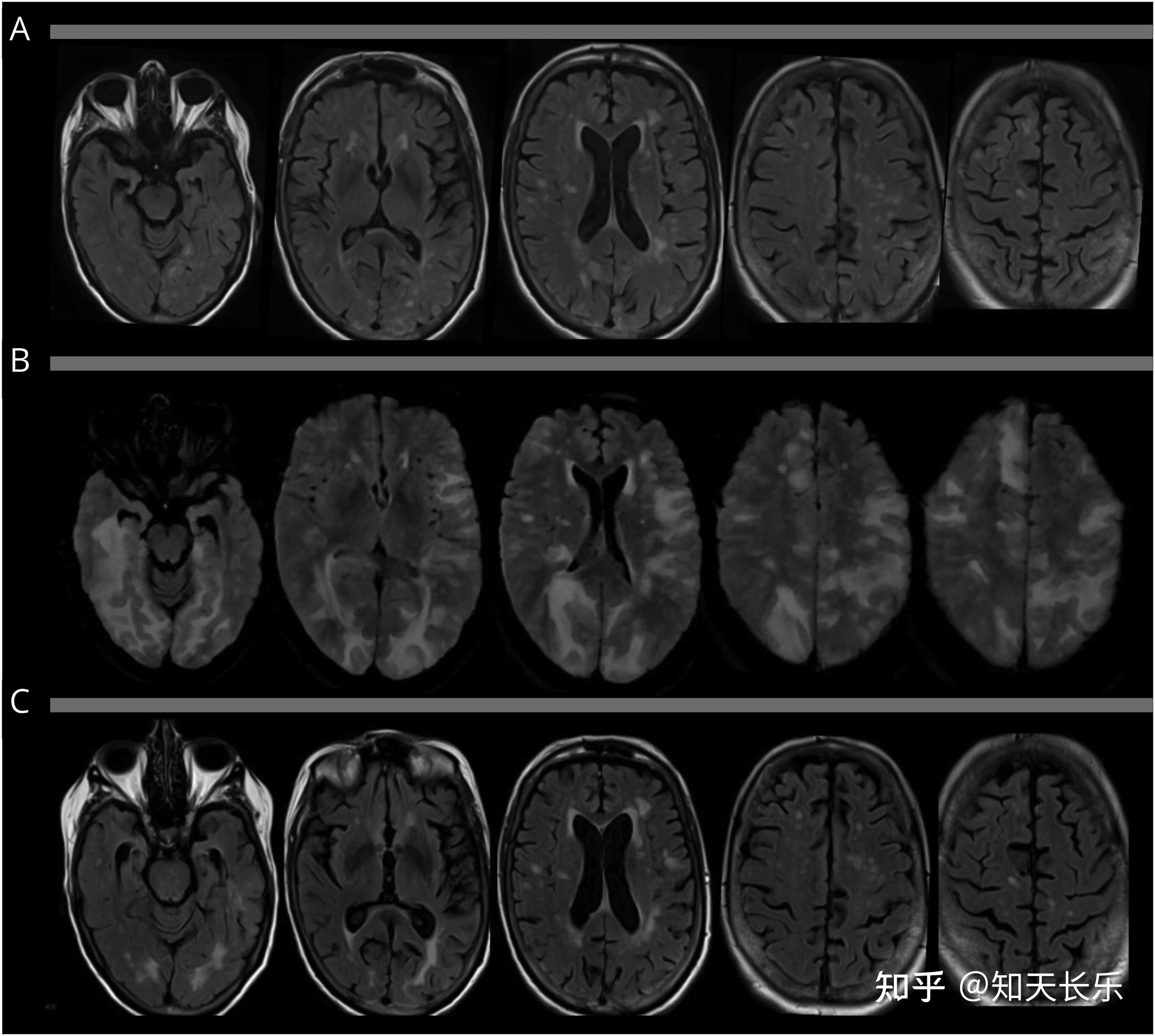 一例抗Aβ单抗Remternetug治疗三周后，引起严重的ARIA-E - 知乎