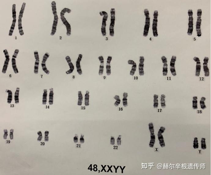 男人多一条X染色体会怎么样？—克氏综合征/Klinefelter 综合征/XXY综合征疾病介绍及应对策略 - 知乎