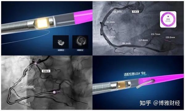 NMPA官宣！中国首个自主创新60MHz高速IVUS上市！ - 知乎