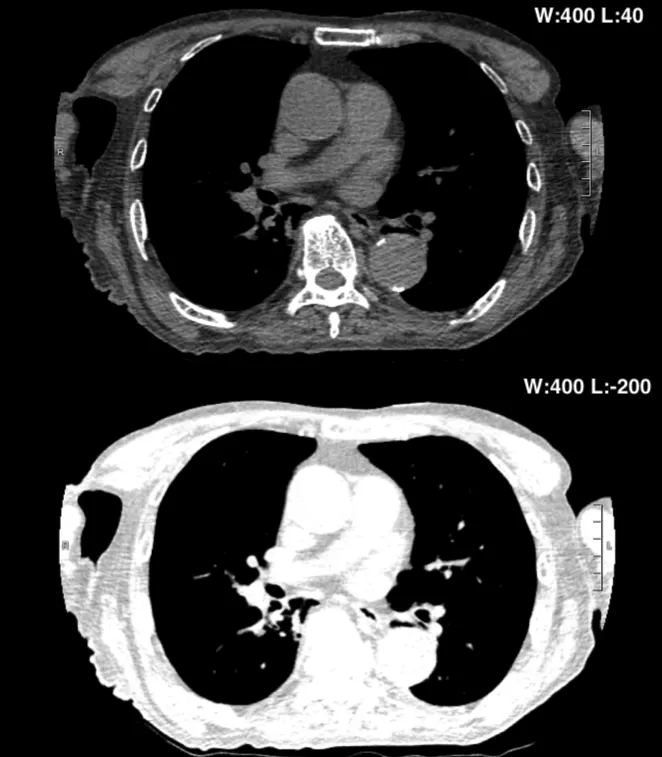 CT-Windowing医学CT图像增强 - 知乎