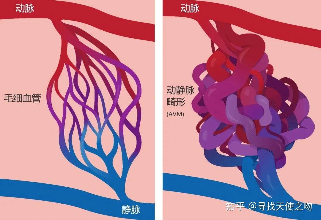 CM-AVM是什么？与普通鲜红斑痣有什么差异？ - 知乎