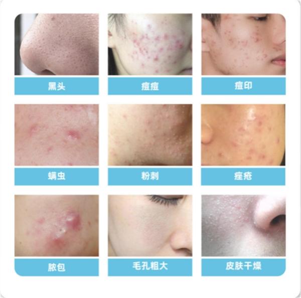 战痘宣颜这份保姆级祛痘指南,被我搞到手啦! 知乎