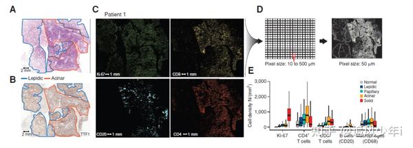 单细胞 & DSP(Digital Spatial Profiler)联合分析解析肺腺癌的转录重编程推动cancer evolution - 知乎