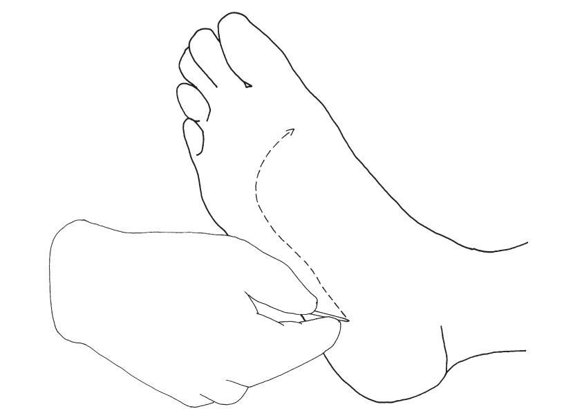 巴宾斯基（Babinski）征怎么查 - 知乎