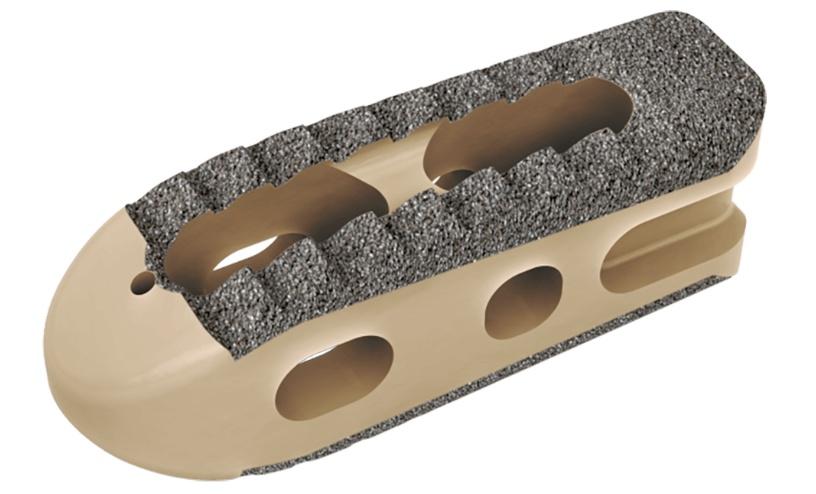 与医生协作开发，脊柱公司Alphatec - 知乎