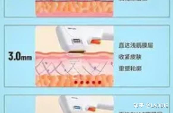 【超刀美盾】对比超声炮图片 超声炮效果对比图太惊人~别再骗人啦! 知乎