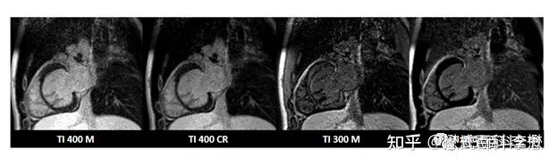 PSIR序列原理及临床应用 - 知乎