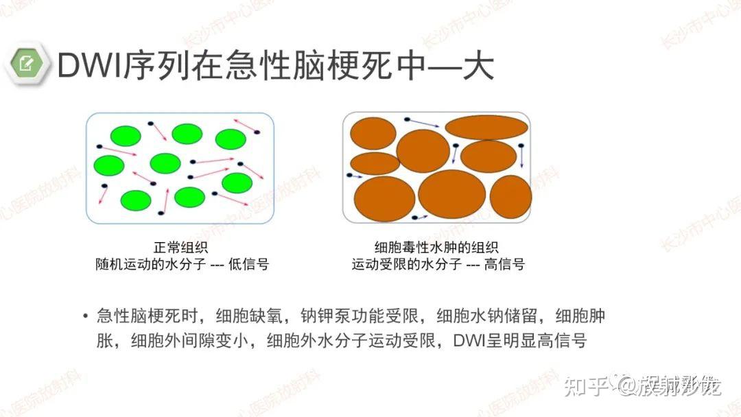 DWI序列判读原则及临床应用 - 知乎