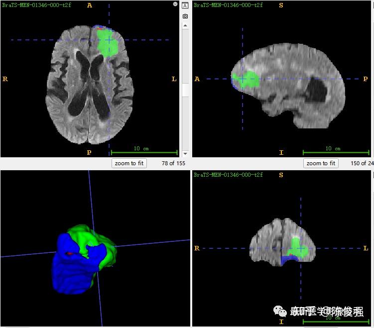 BraTS2023-MEN——BraTS2023颅内脑膜瘤分割挑战赛 - 知乎