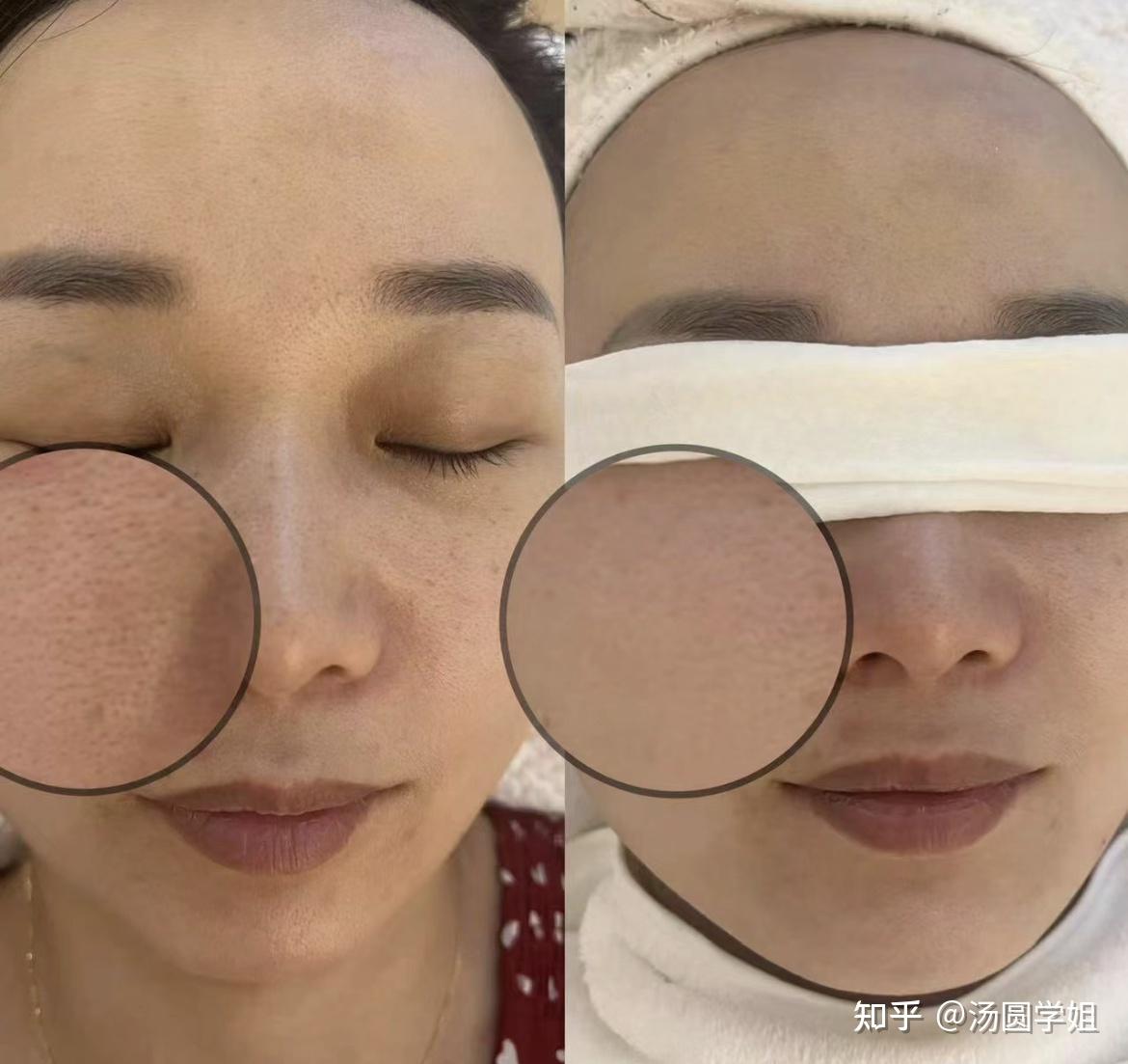超光子跟普通光子嫩肤有什么区别？日常皮肤保养如何搭配医美项目及周期安排？