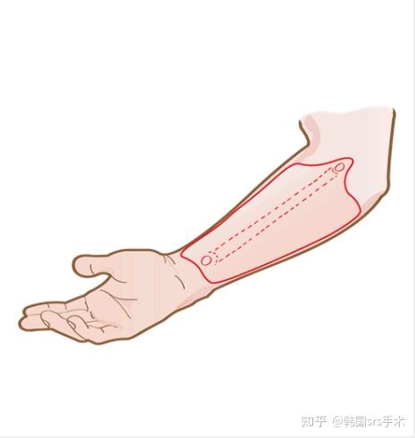 FTM（Phalloplasty）阴茎形成术具体怎么做？ - 知乎