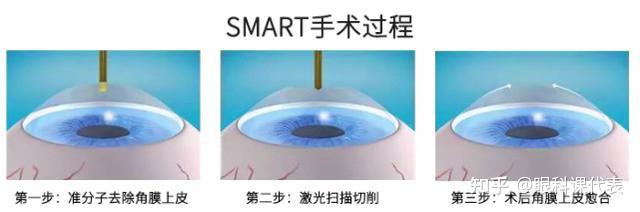 全飞、半飞、全激光、tprk、ICL区别「选择tips」 - 知乎