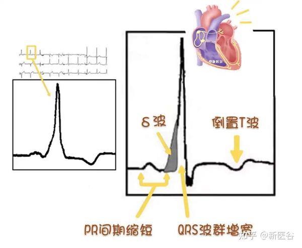 谷谷给你讲解WPW综合征 - 知乎