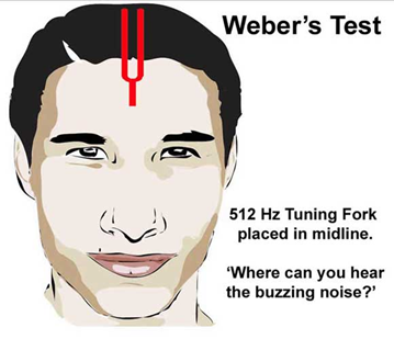 Rinne test vs Weber test - 知乎