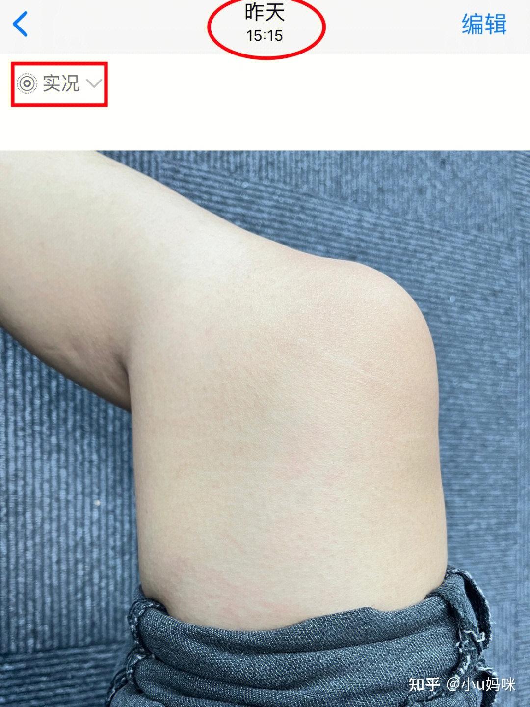 在大腿上5年的肥胖纹就这么淡化掉了！长在腿上太丑试试这个好用又惊艳淡纹方法，保让你赞不绝口！ 知乎