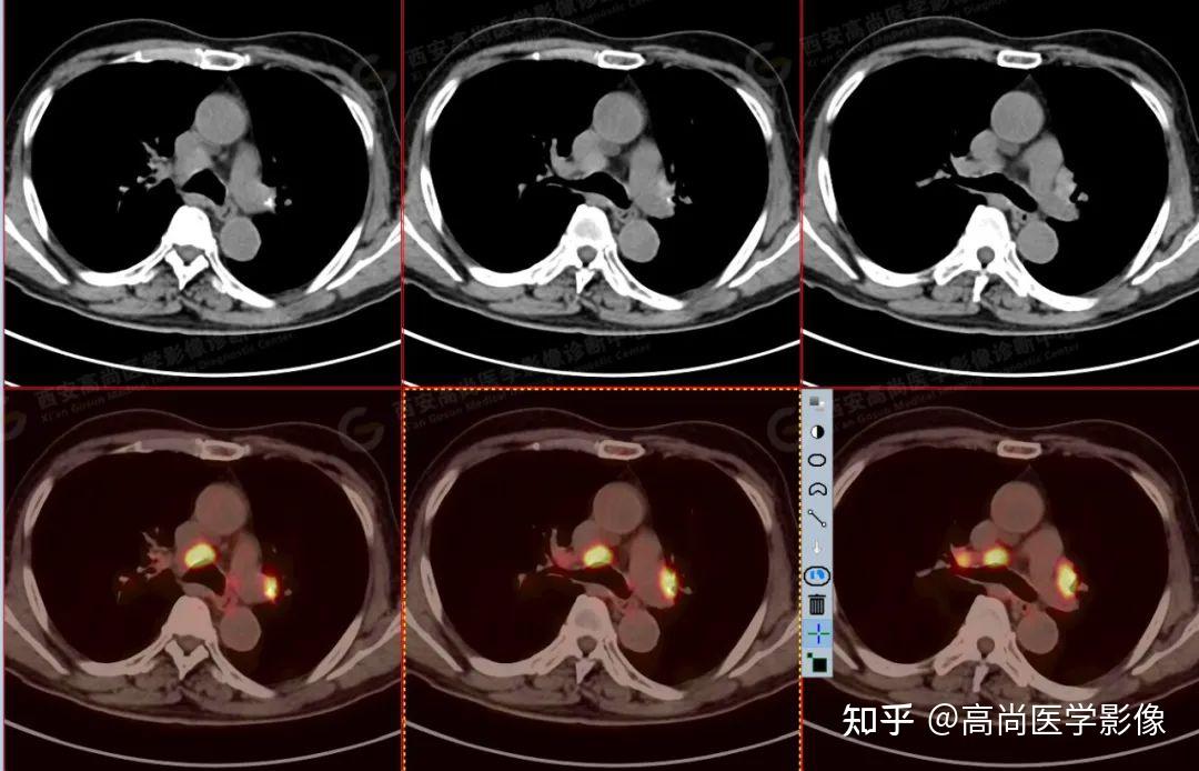 PET/CT病例：肺鳞癌5例【高尚医学影像】 - 知乎