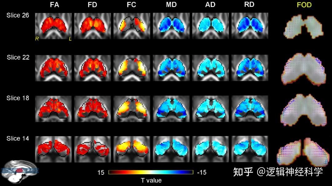 J Neurosc︱首次！围产期丘脑形态学、微结构和连通性的时空发育模式 - 知乎