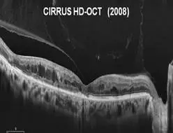 医疗器械技术解析- 什么是OCT - 知乎