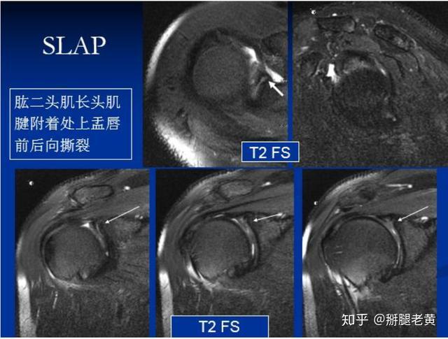 肩膀SLAP损伤是什么病？关于SLAP损伤这六点你需要注意 - 知乎