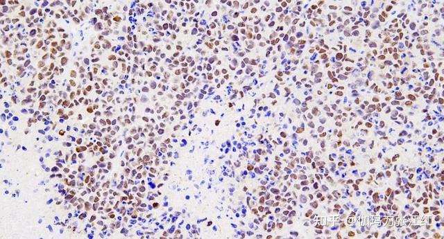 一文看懂Ki67，数值越高预后越不好？ - 知乎