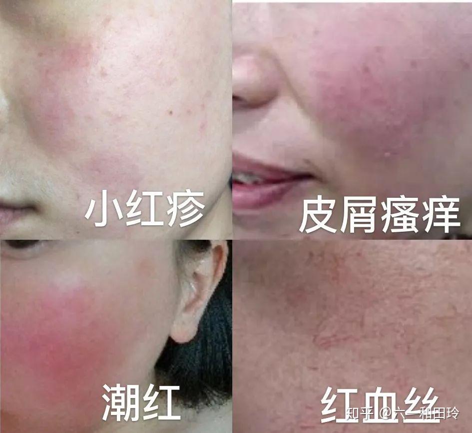 敏感肌肤如何修复 知乎