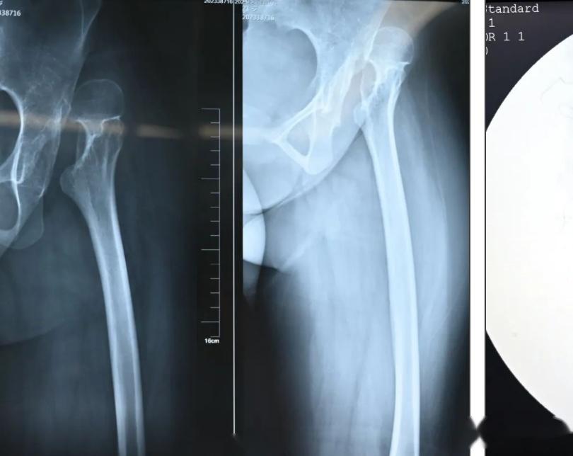井陉县医院：首例！机器人辅助下后外侧入路（DAA）全髋关节置换术顺利完成！ - 知乎