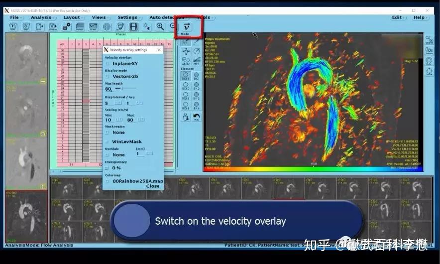 心脏磁共振技术大全（四） - 知乎