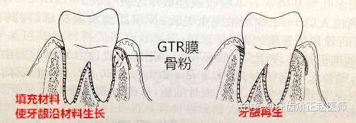牙龈萎缩了,还可以长回来吗? 知乎