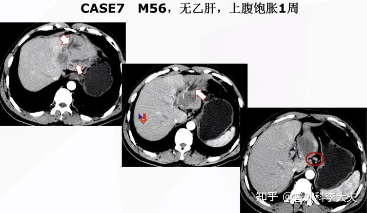早期肝癌术后如何避免复发？ - 知乎