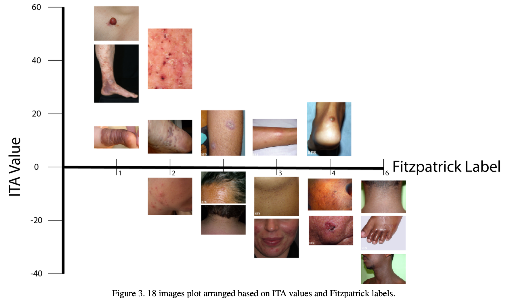 Fitzpatrick 17k 皮肤状况和肤色分类数据集介绍 - 知乎