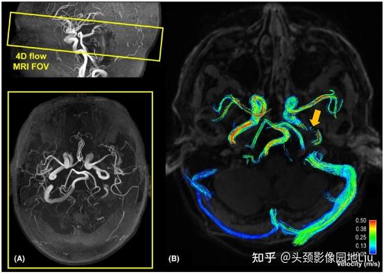 一起看懂4D FLOW MRI 参数（上） - 知乎