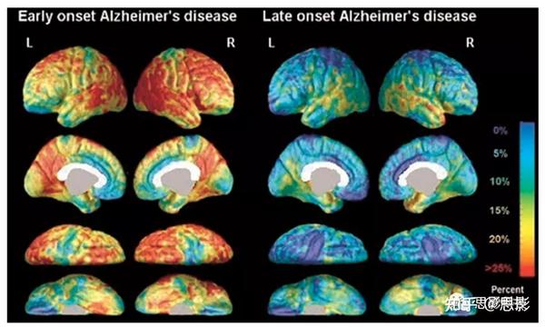 阿尔茨海默病与正常衰老中的脑萎缩研究进展 - 知乎