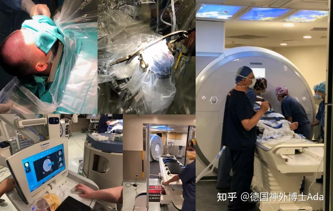 全国首例磁共振实时监测颅内激光消融(LITT)手术在北京天坛医院完成，LITT究竟是何黑科技？ - 知乎