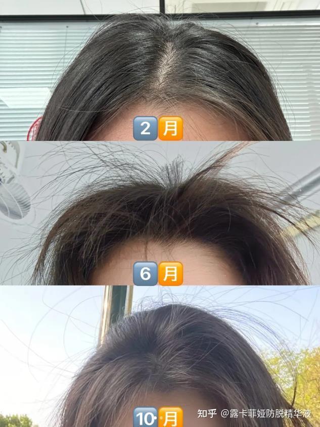 全网育发液什么牌子最有效果？国家防脱发生发育发排行榜第一名，合格之选 - 知乎