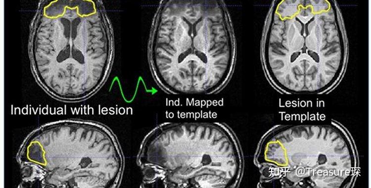 Python科研图像处理——ANTs多模态配准 - 知乎