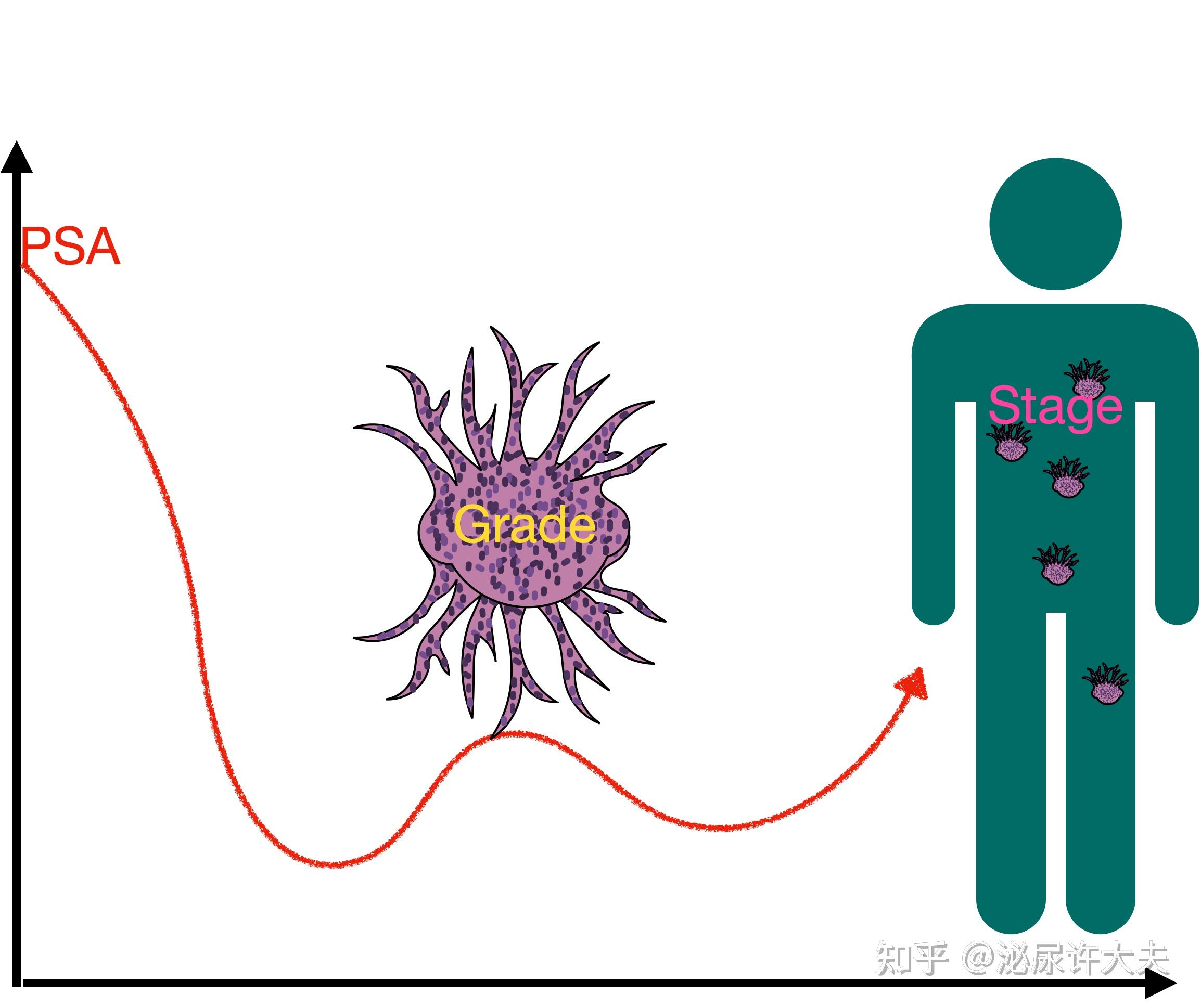 影响前列腺癌患者病情严重程度的重要指标有哪些? 知乎