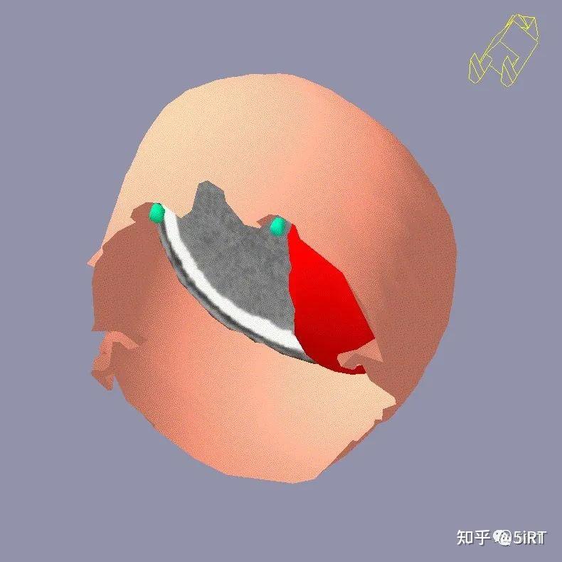 放疗数据传输标准DICOM RT - 知乎