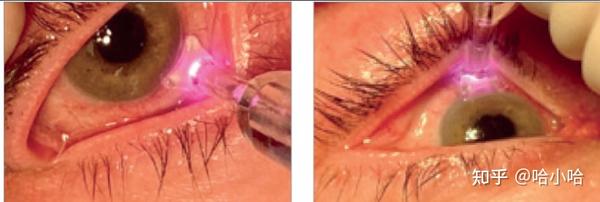 带你了解MicroPulse®跨巩膜激光治疗青光眼：国际德尔福小组的指南 - 知乎