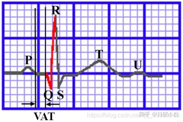 心电图基础知识 - 知乎