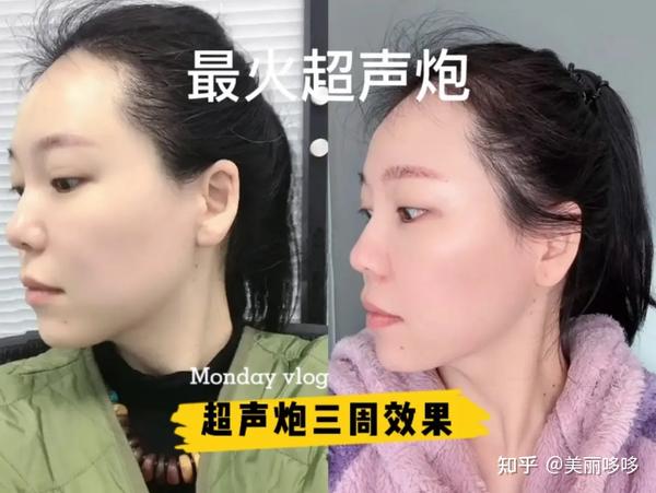 半岛超声炮全脸做一次多少钱,单 全模式的区别避免被坑 知乎