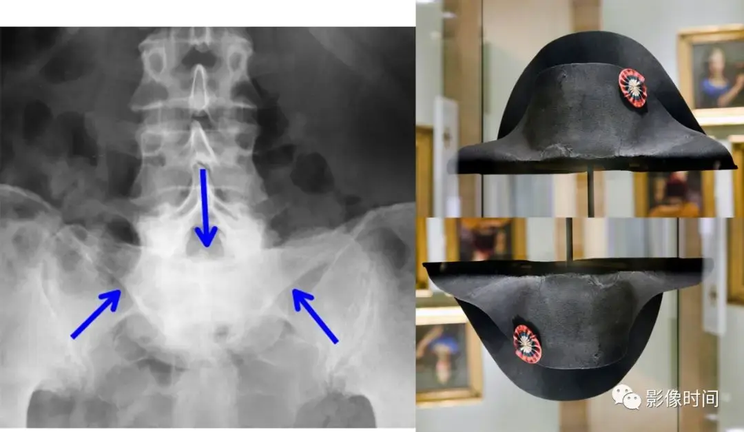 三十种脊柱影像征象，你见过几种？ - 知乎