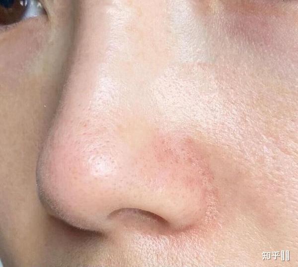 从自己身上扣下来最大的黑头有多大? 知乎