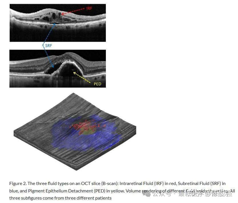 RETOUCH2017——视网膜OCT积液分割挑战赛 - 知乎